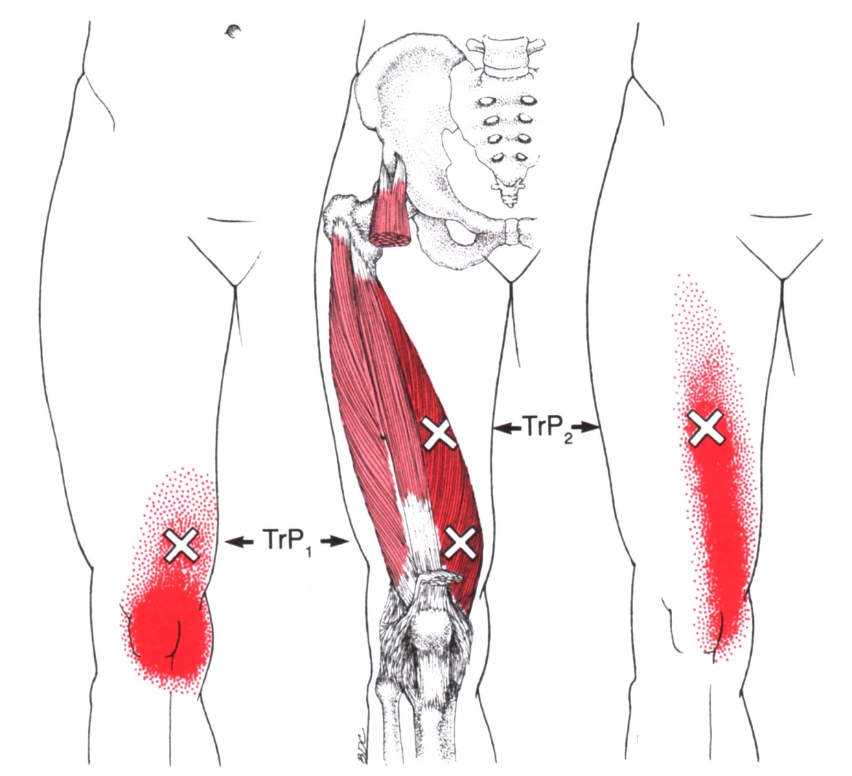 Vastus Medialis | The Trigger Point & Referred Pain Guide Vastus Medialis | The Trigger Point & Referred Pain Guide